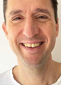 Ny professor forsker i kompleks kirurgi gennem pulsårer i lysken